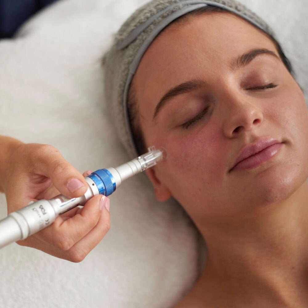 Skin Needling Melbourne - Microneedling & Derma Rolling Treatment ...