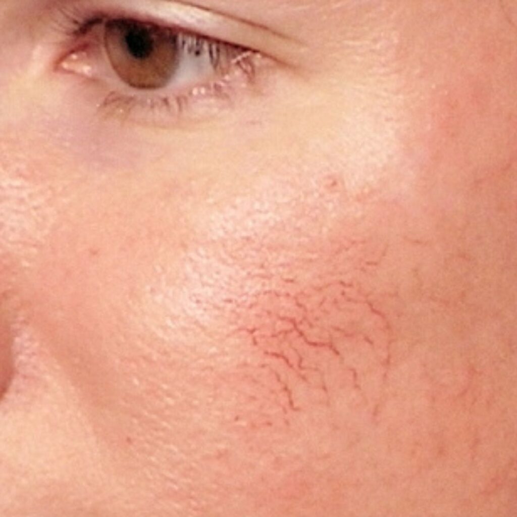 IPL Laser Skin Rejuvenation | Intense Pulsed Light Treatment ...