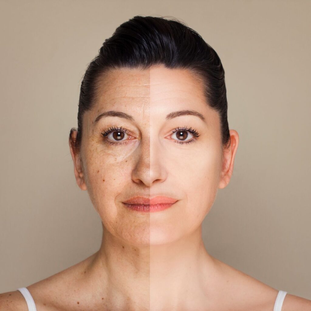 IPL Laser Skin Rejuvenation | Intense Pulsed Light Treatment ...